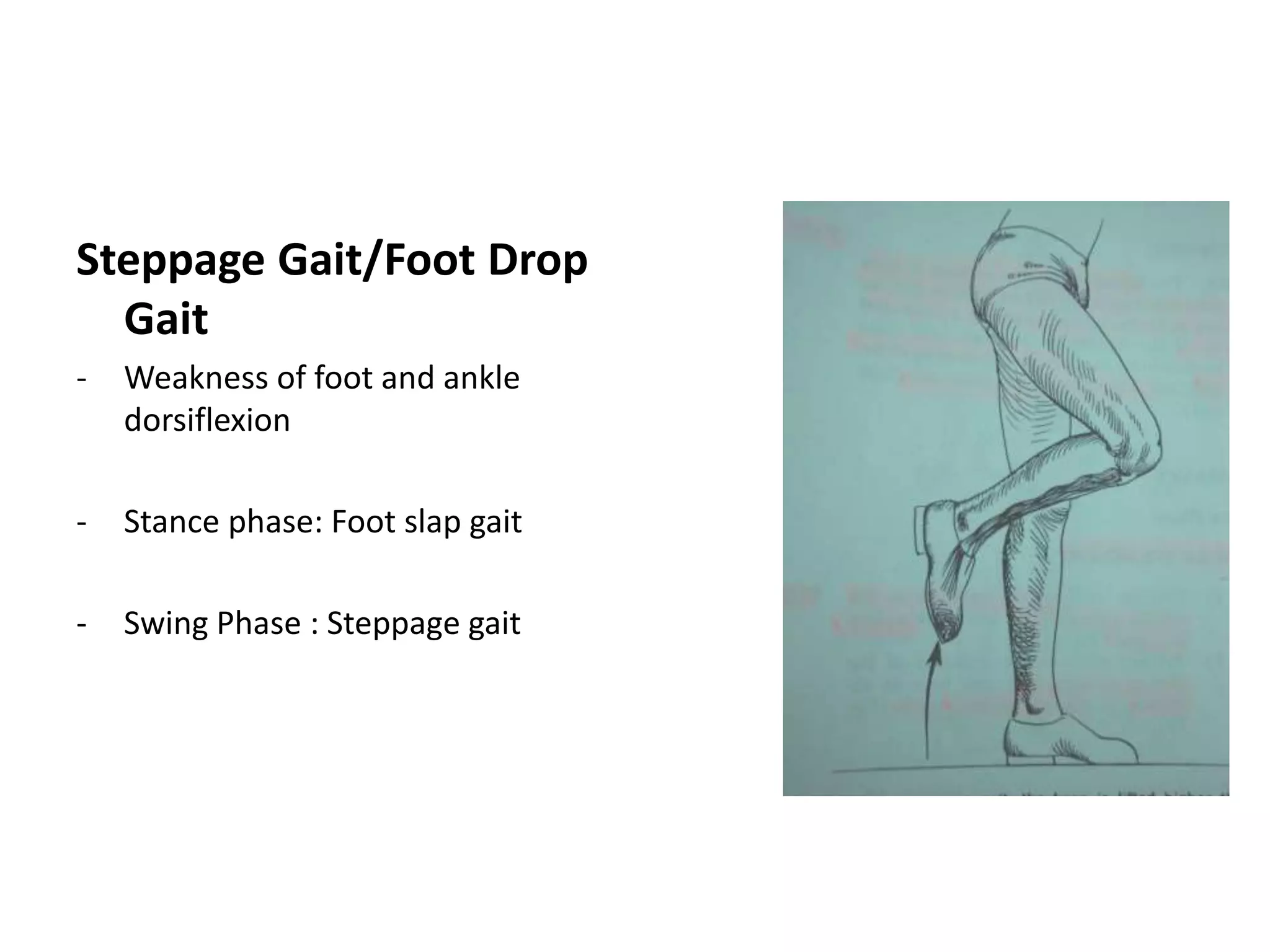 An approach to limping child | PPTX