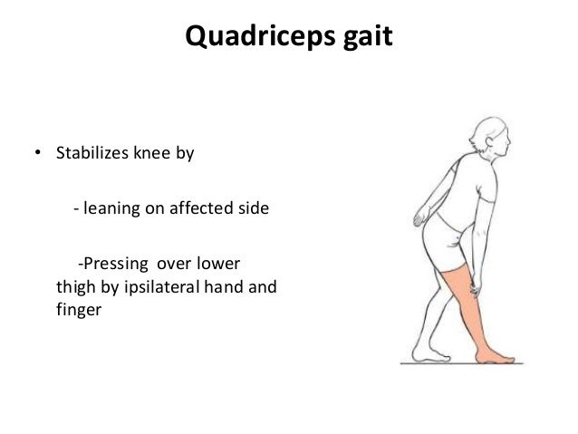 An approach to limping child