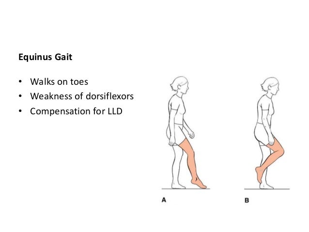 An approach to limping child
