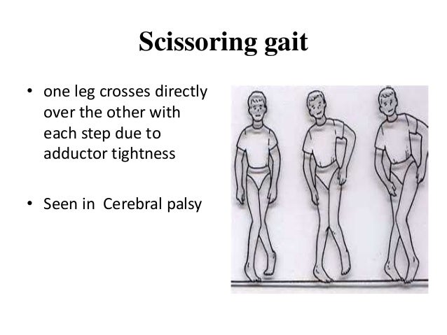 An approach to limping child