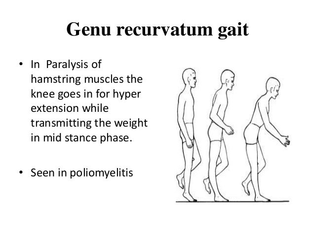 An approach to limping child