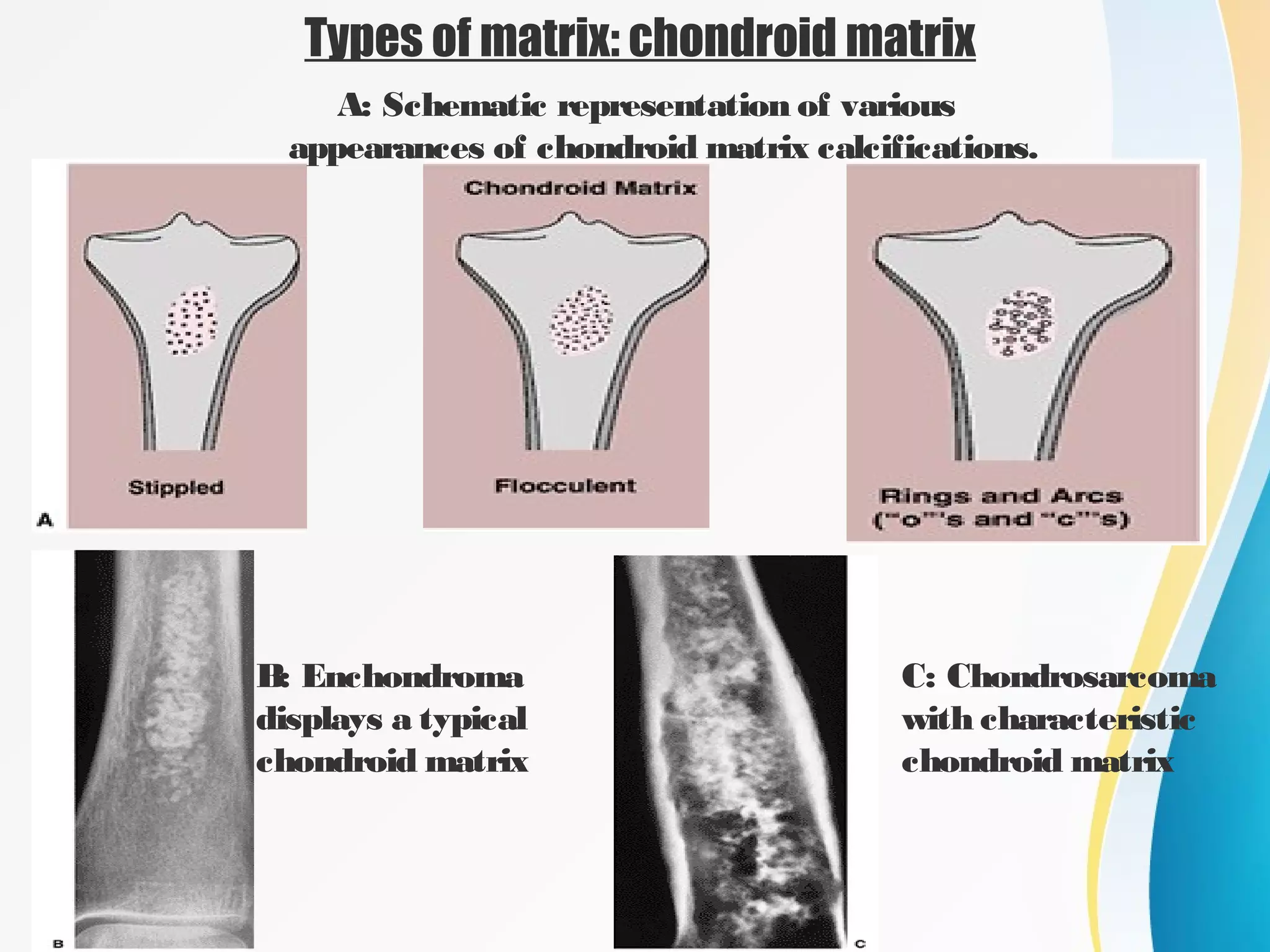 An approach to malignant bone tumors | PPT