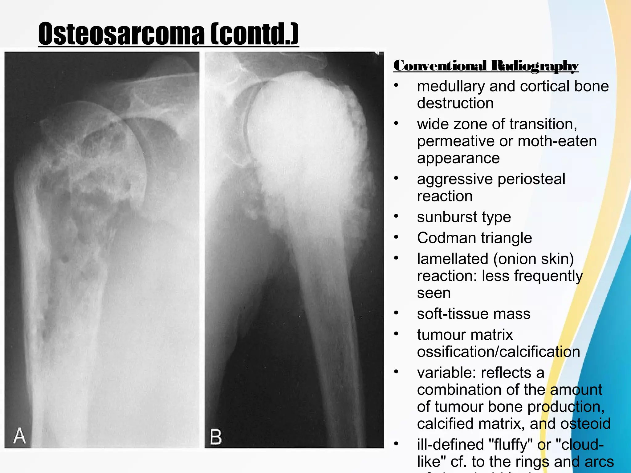 An approach to malignant bone tumors | PPT