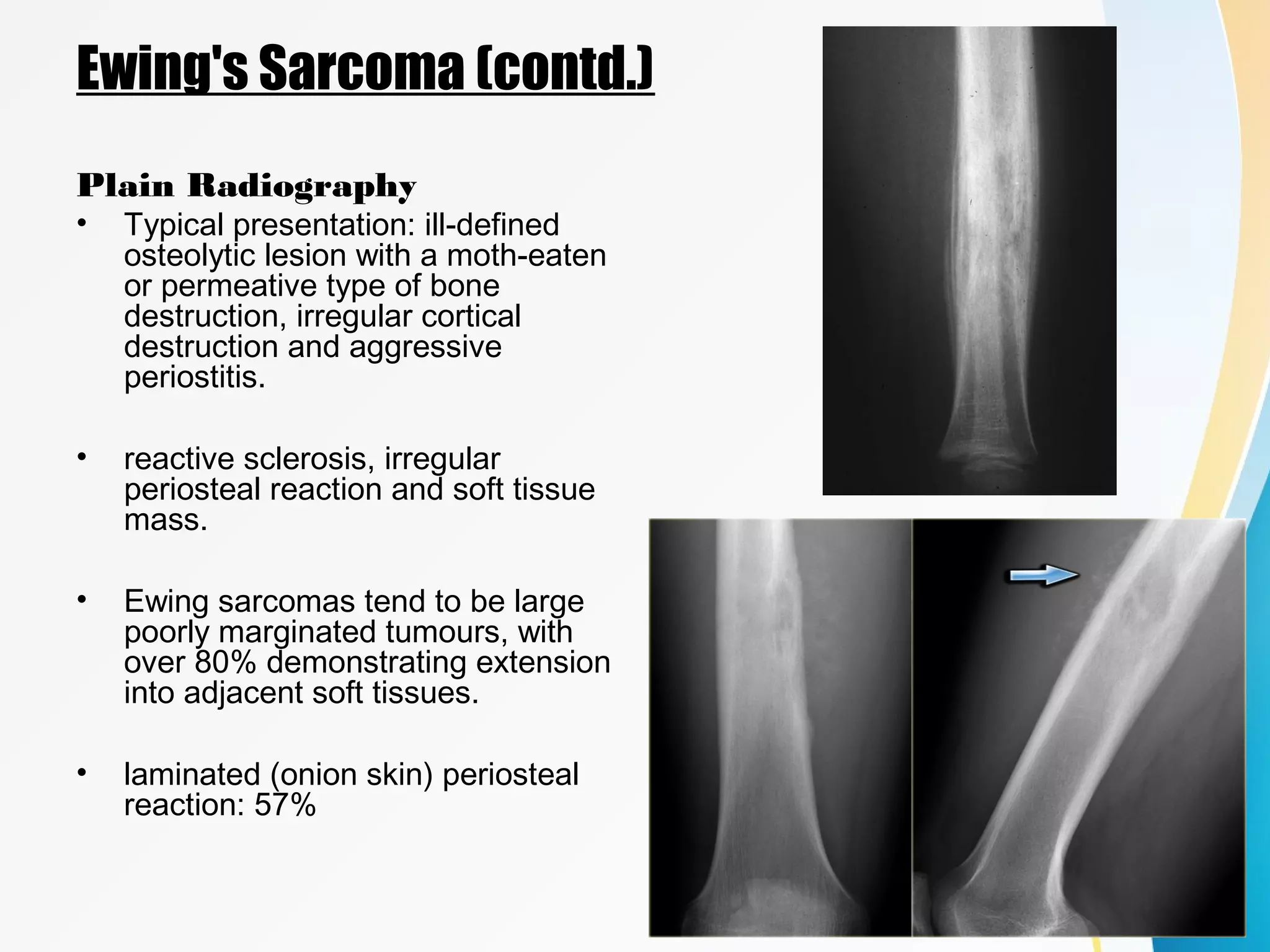 An approach to malignant bone tumors | PPT