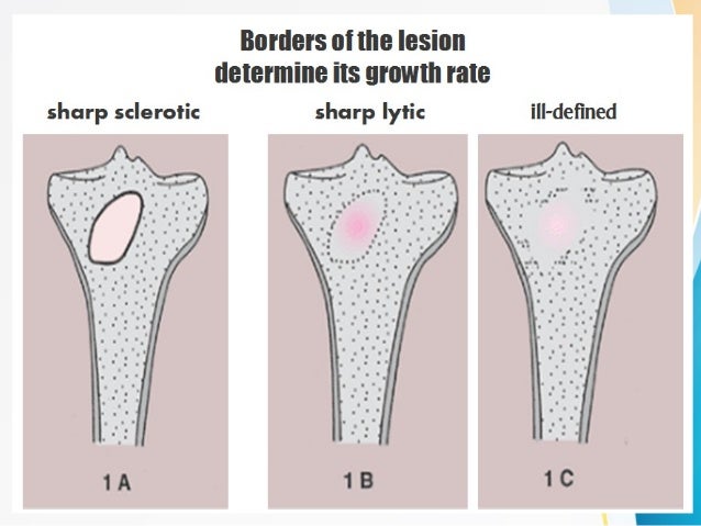 An approach to malignant bone tumors