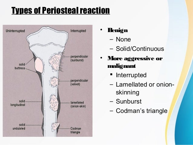 An approach to malignant bone tumors