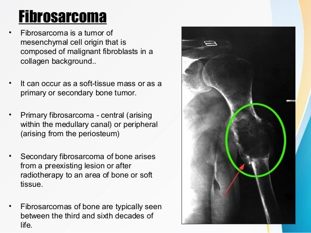 An approach to malignant bone tumors