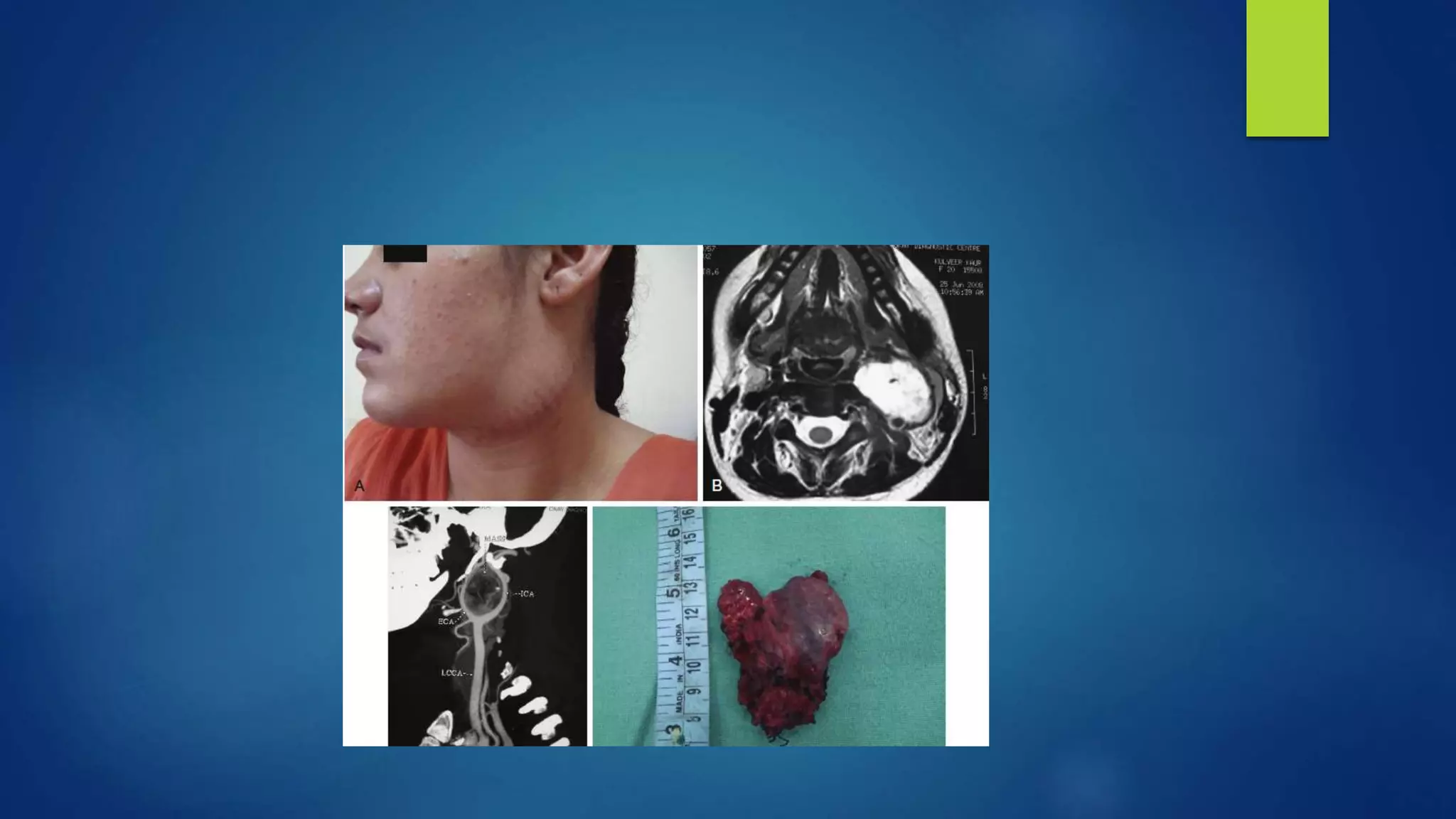 An Approach To The Neck Mass Ppt