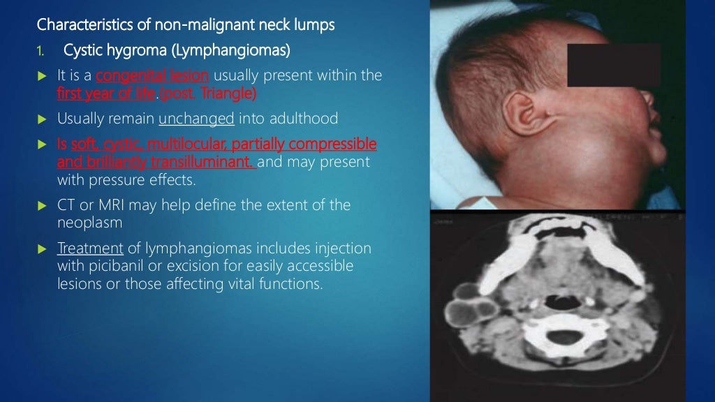 An Approach To The Neck Mass