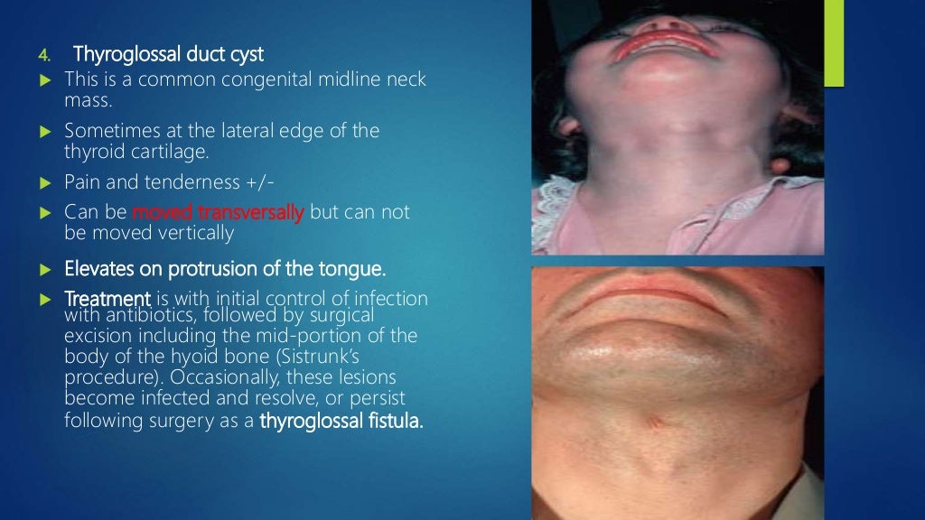 An approach to the neck mass