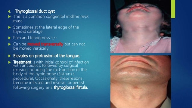 An approach to the neck mass