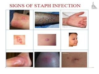 An approach to the patient with recurrent skin abscesses | PPT