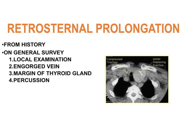 An approach to_thyroid_swelling_seminar_final | PPTX