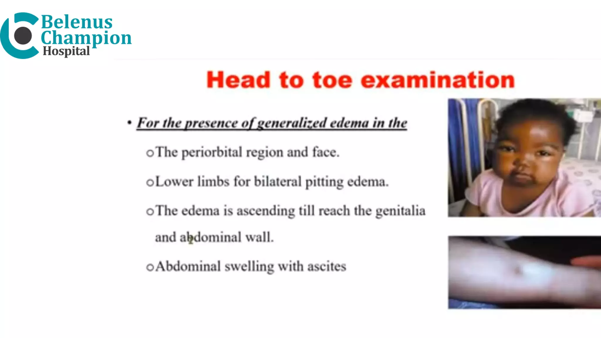 ANASARCA IN CHILDREN - WPS Office.pptx