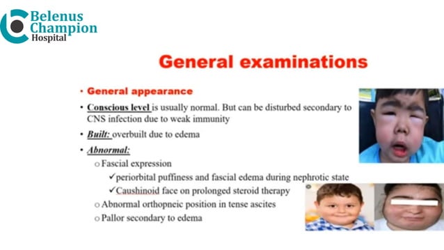 ANASARCA IN CHILDREN - WPS Office.pptx