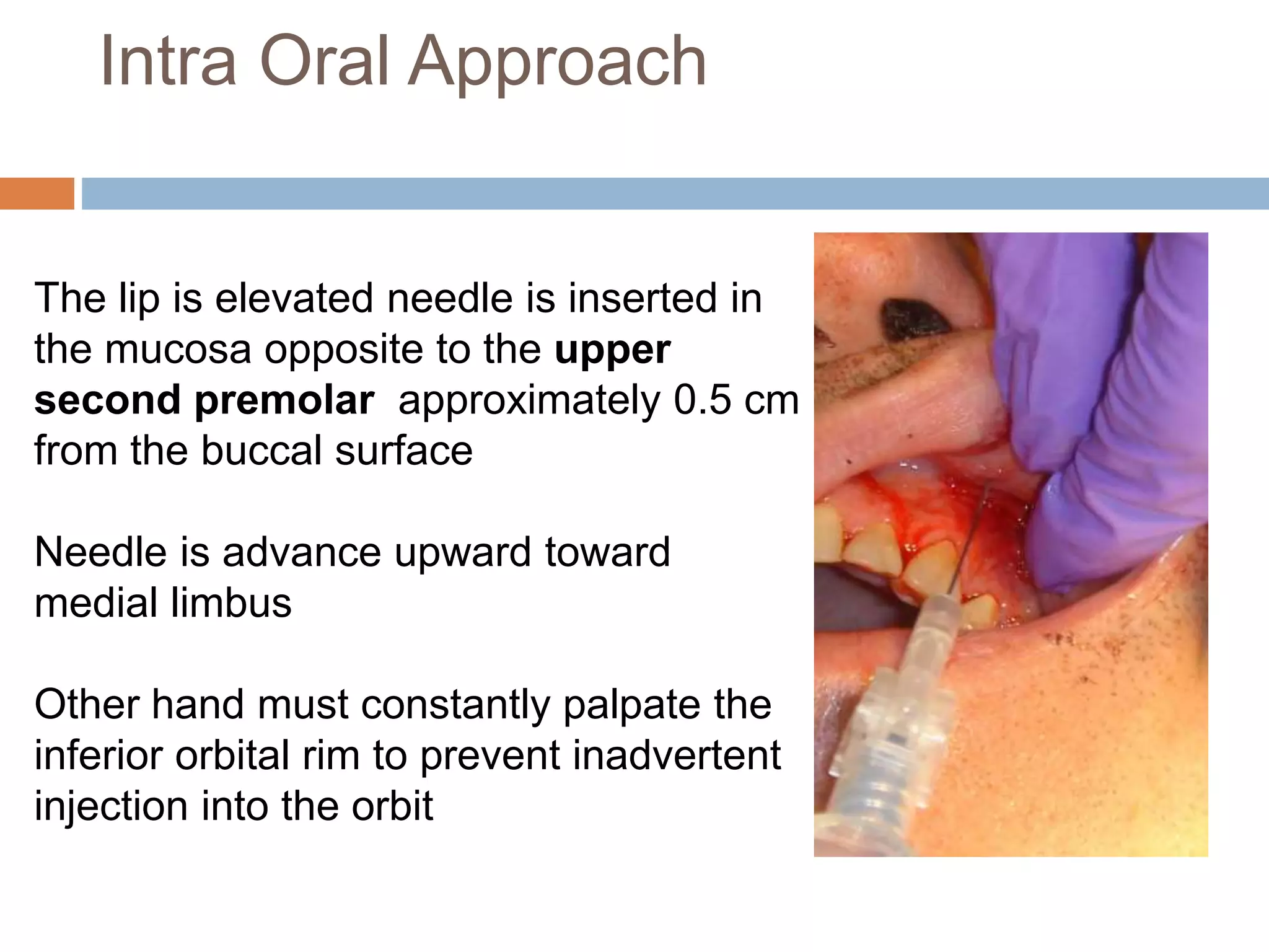 Local Anaesthesia In Plastic Surgery | PPTX