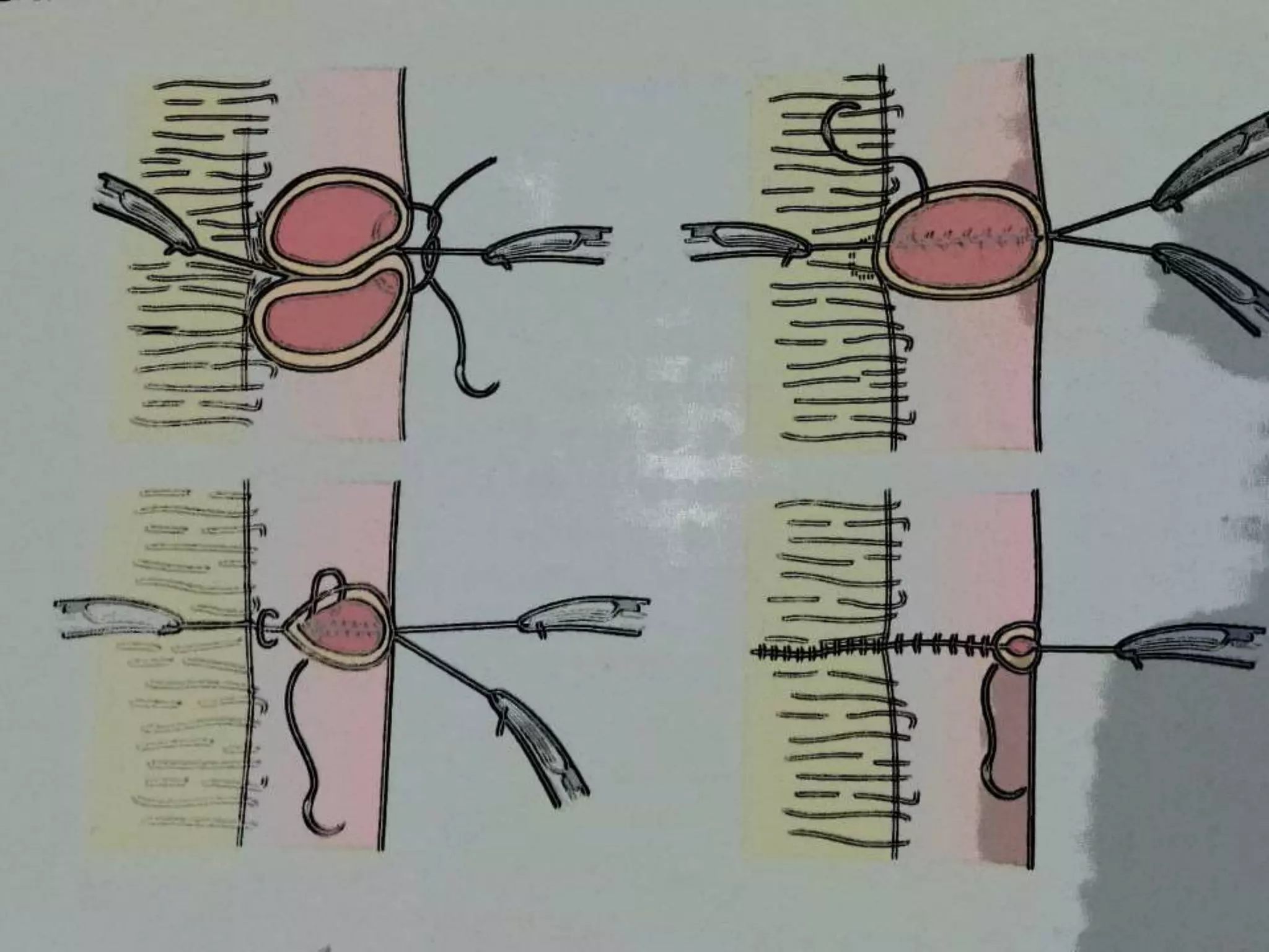 Anastomosis | PPTX