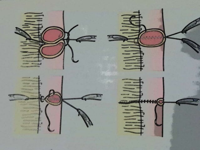 Anastomosis | PPTX