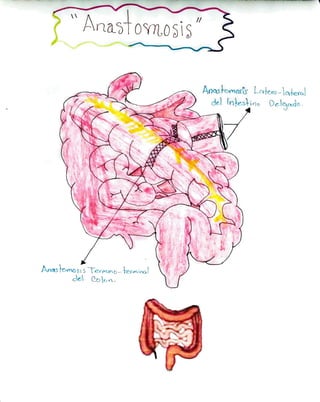 Anastomosis Intestinal termino-terminal, latero-lateral y termino ...