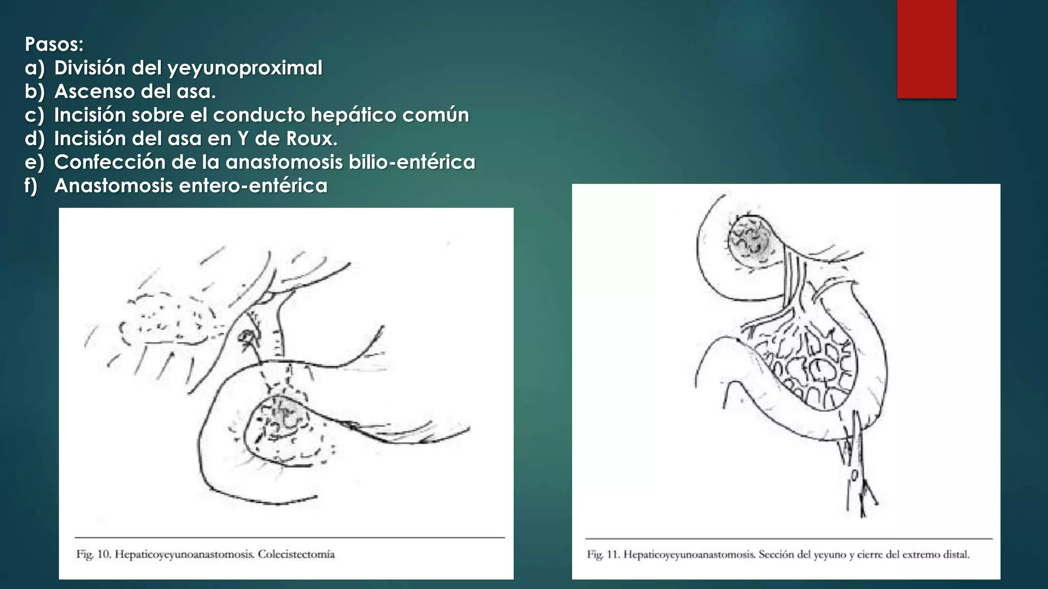 Anastomosis bd | PPTX | Surgery | Medical Health