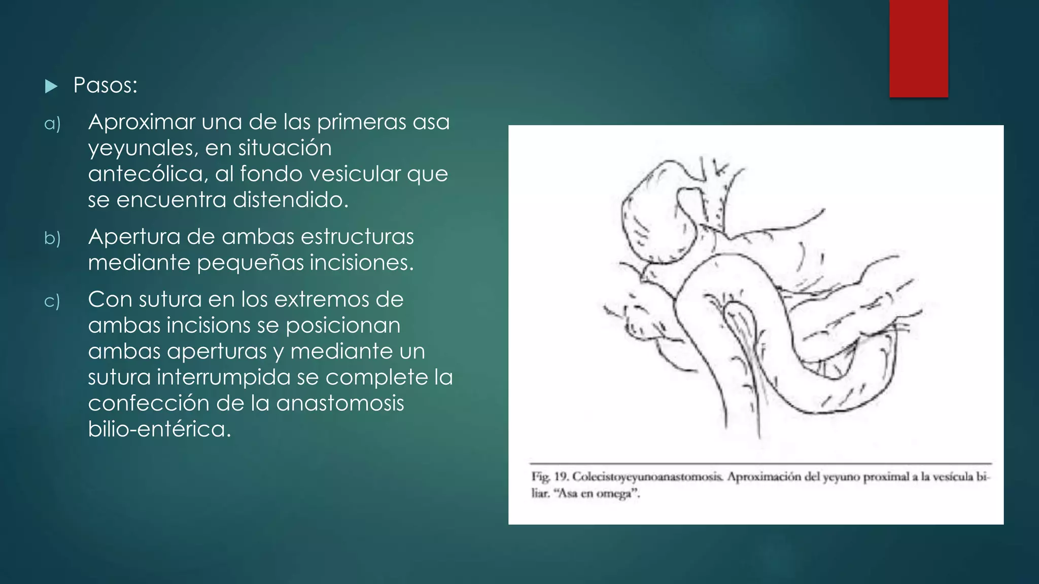Anastomosis bd | PPTX