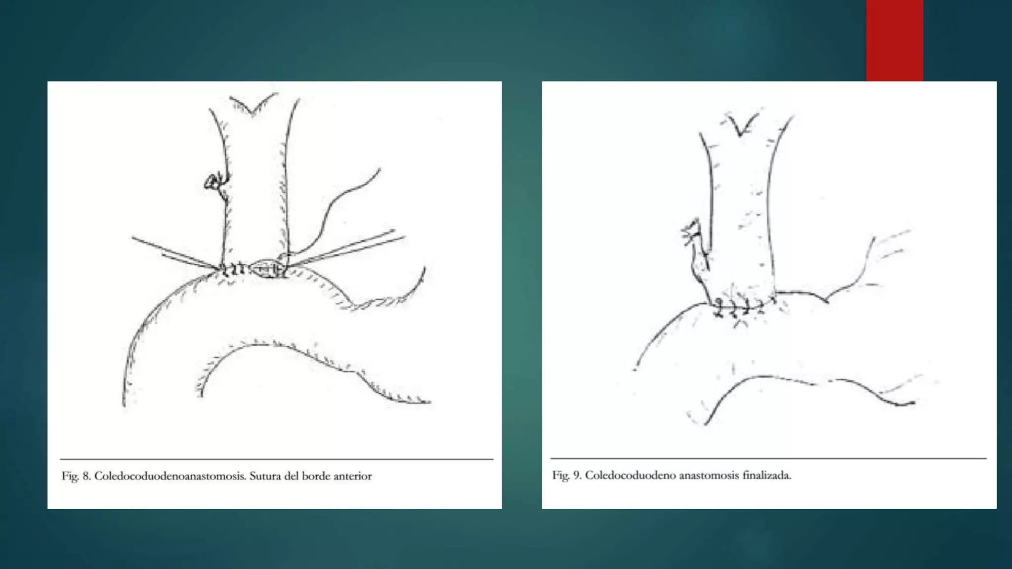 Anastomosis bd | PPTX