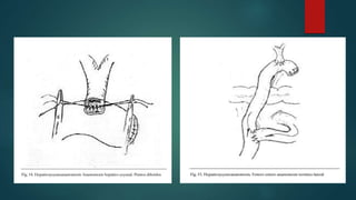 Anastomosis bd | PPTX