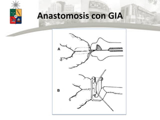 Anastomosis intestinales | PDF