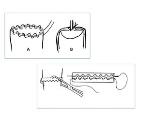 Anastomosis intestinales | PDF