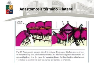 Anastomosis intestinales | PDF