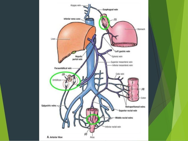 Anastomosis porta cava