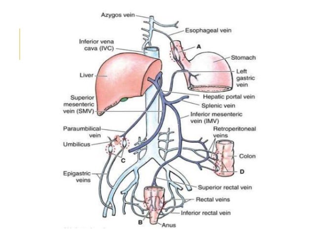 Anastomosis Porto-Cava