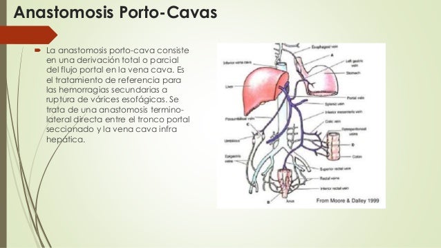 Anastomosis porto cava