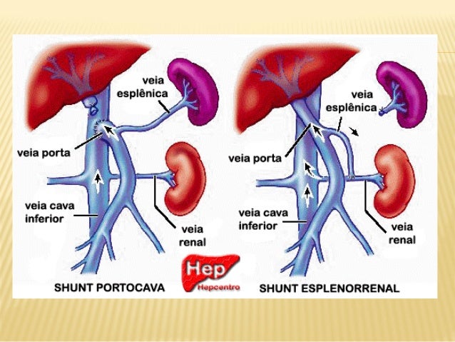 Anastomosis porto cavas