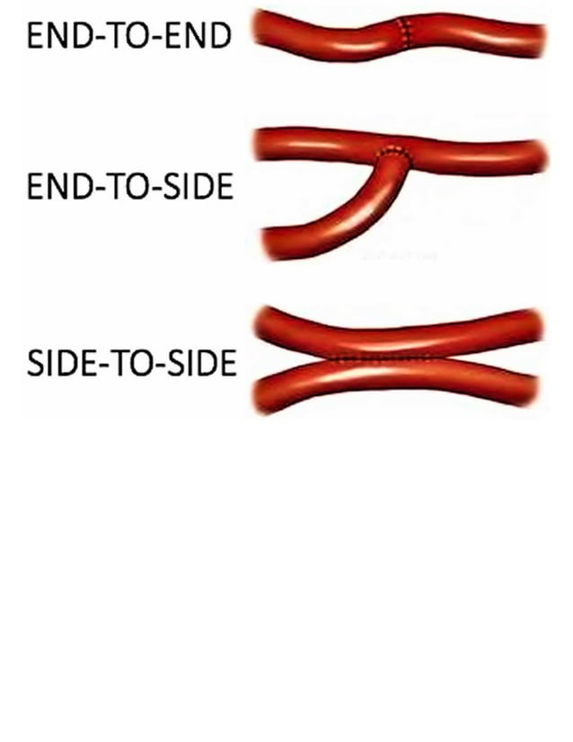 Anastomosis surgery | PDF | Digestive Disorders | Diseases and Conditions