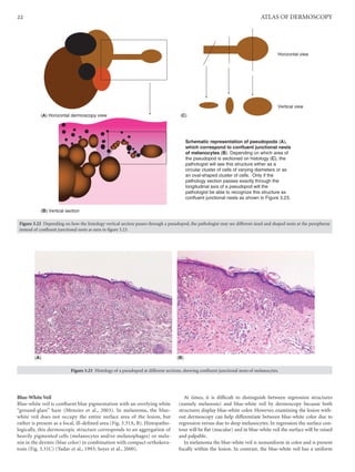 An Atlas of Dermoscopy, Second Edition ( PDFDrive ).pdf