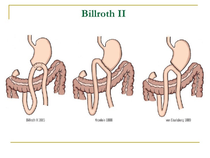 Billroth Ii