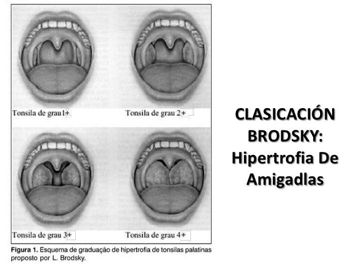 Anatomía amigdala y faringoamigdalitis