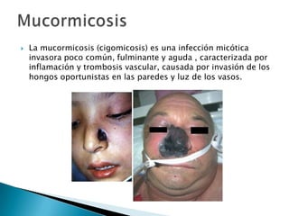 Anatomía de la orbita, celulitis preseptal, celulitis orbitaria y ...