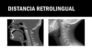 Anatomía de la Vía aérea para anestesi+ologos | PPTX