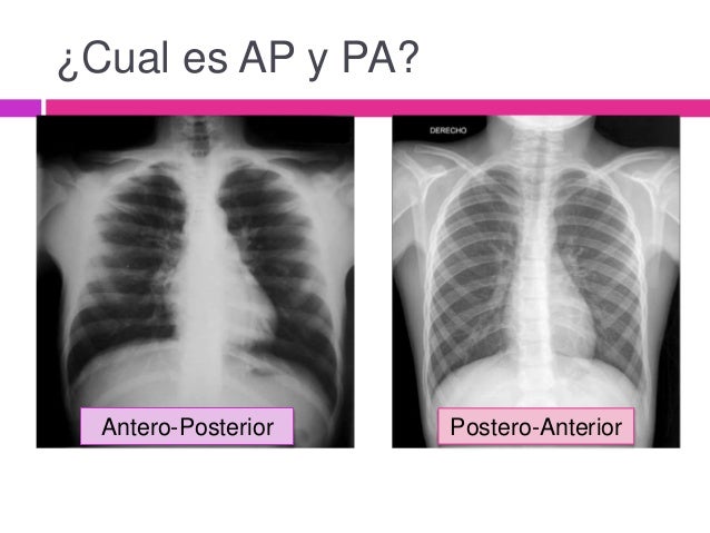 Anatomía de tórax y radiología de tórax normal