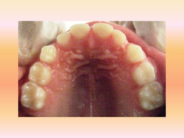 Anatomía dientes temporales