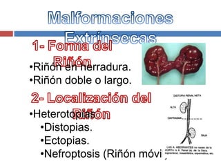 Anatomía Patológica: Riñón | PPTX