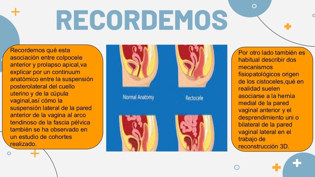 Prolapso Y Sexualidad at Herman Stpierre blog