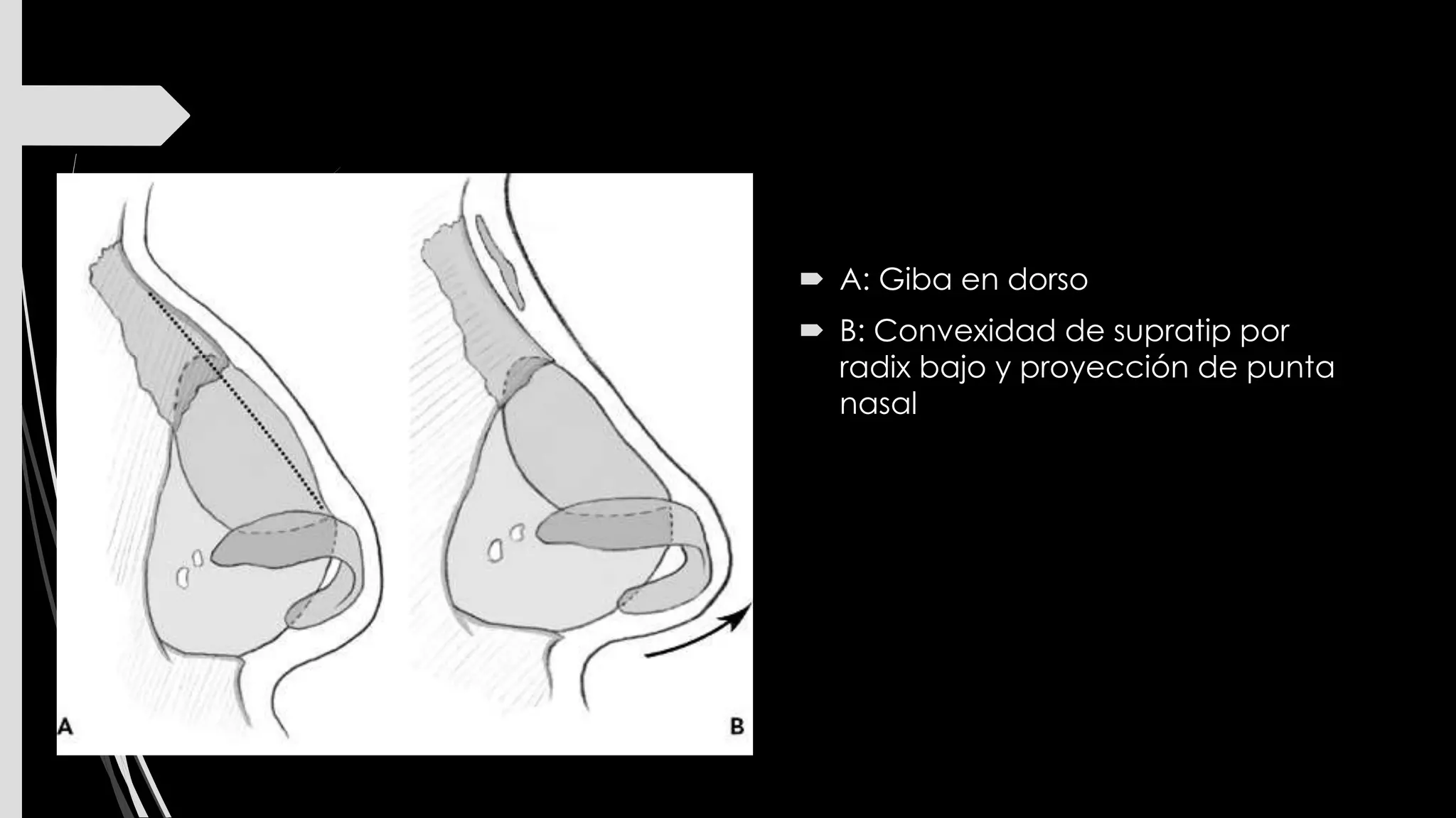 Anatomía quirúrgica de la nariz | PPT