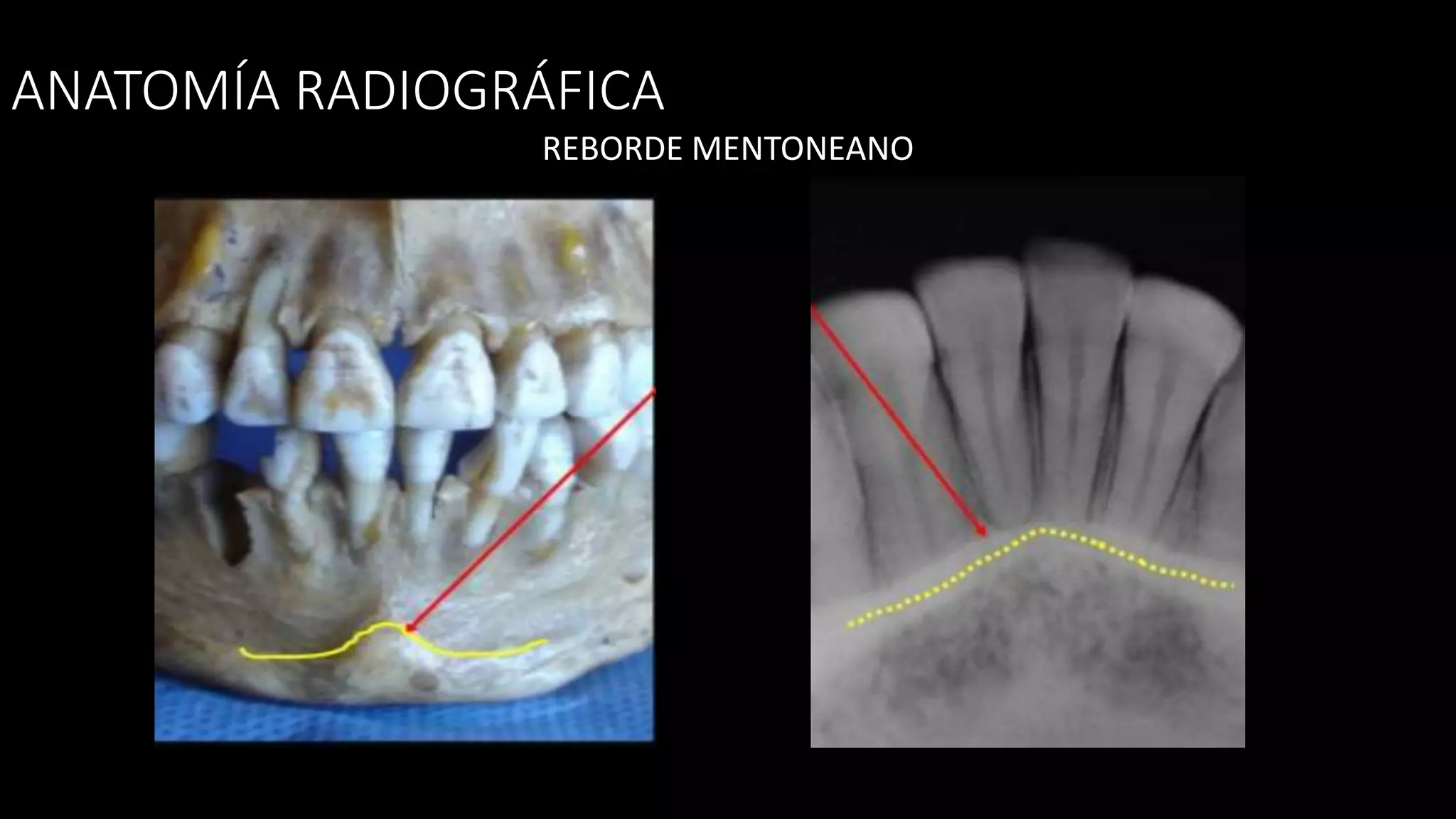 ANATOMÍA RADIOGRAFICA MAXILAR INFERIOR | PPT