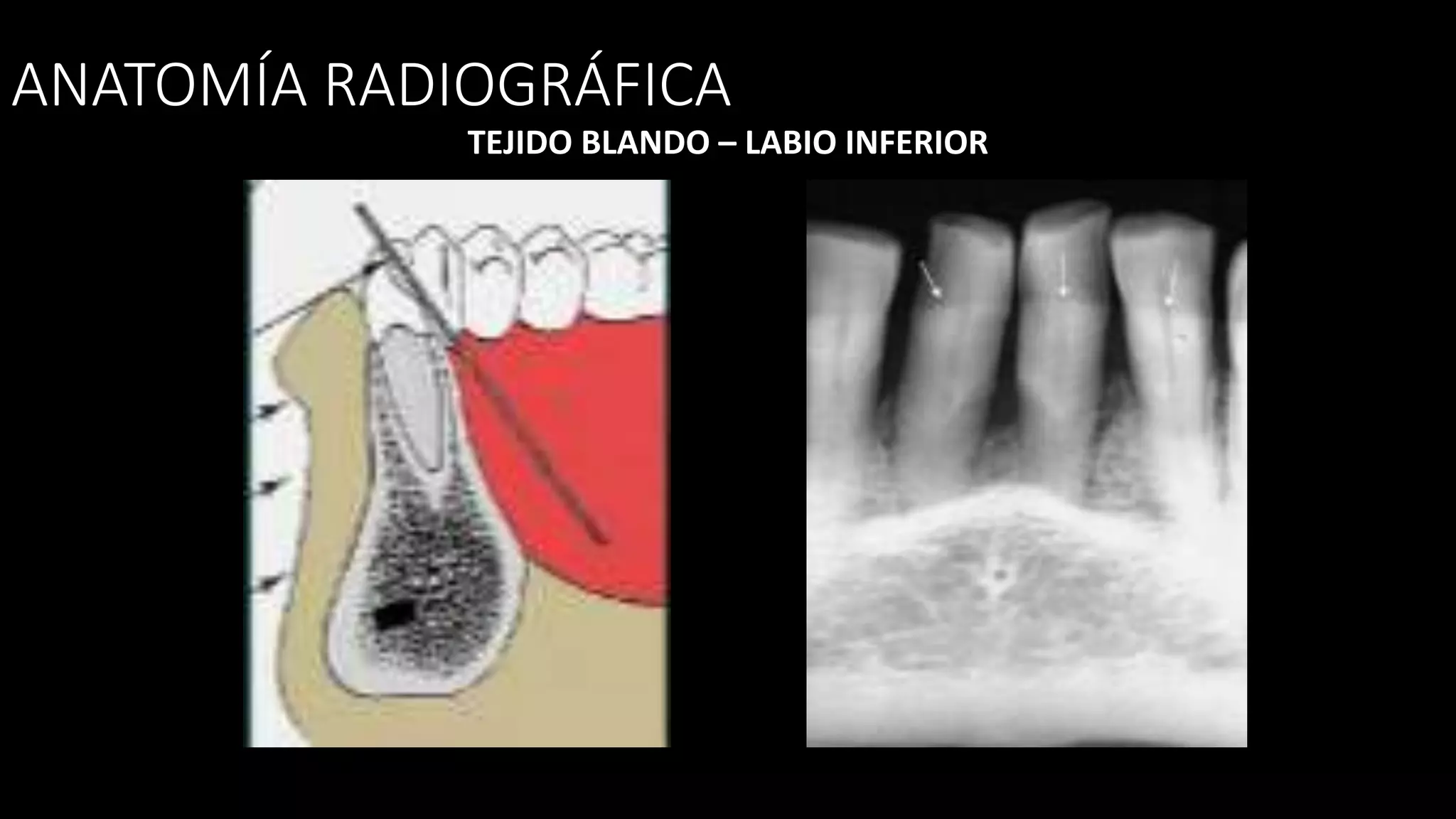 ANATOMÍA RADIOGRAFICA MAXILAR INFERIOR | PPT