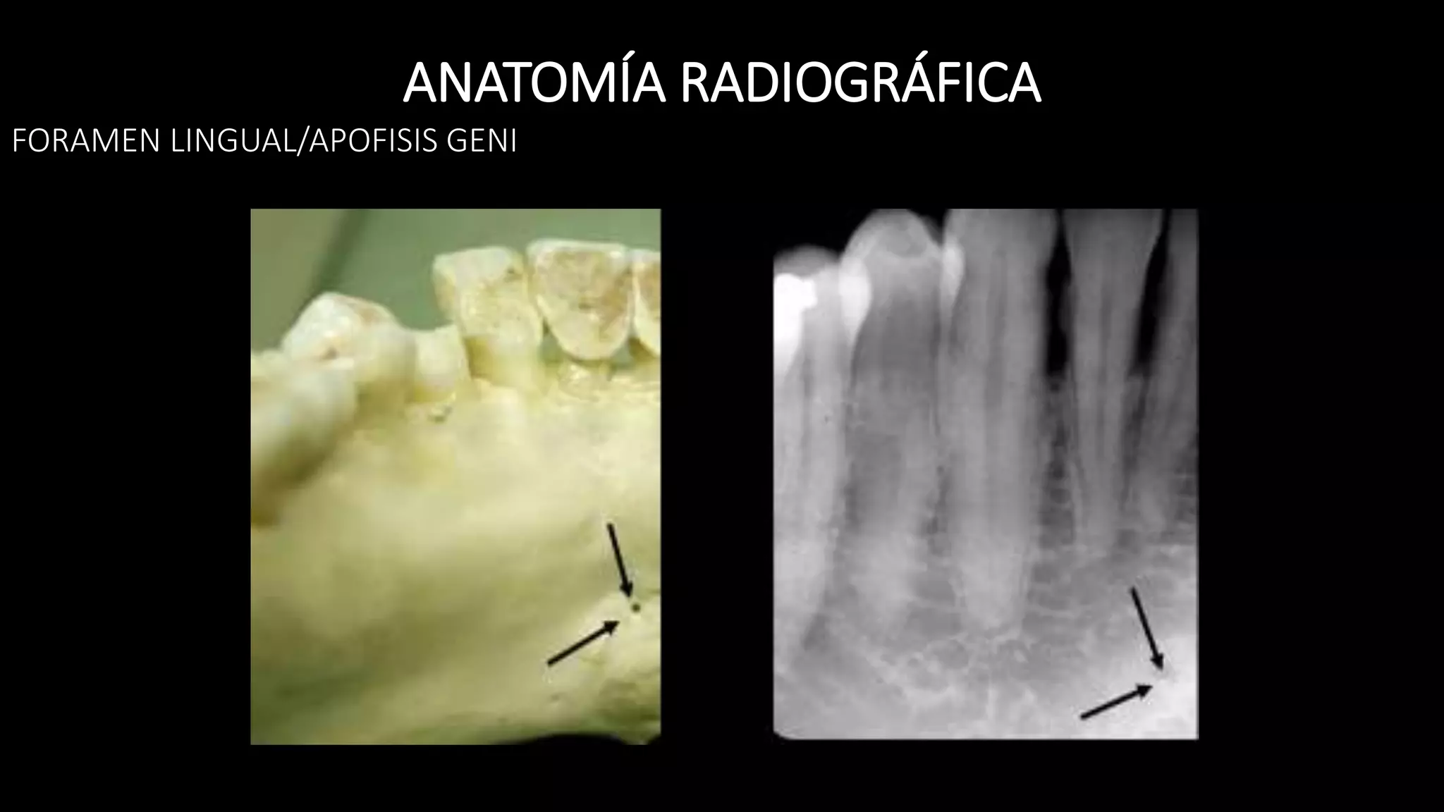 ANATOMÍA RADIOGRAFICA MAXILAR INFERIOR | PPT