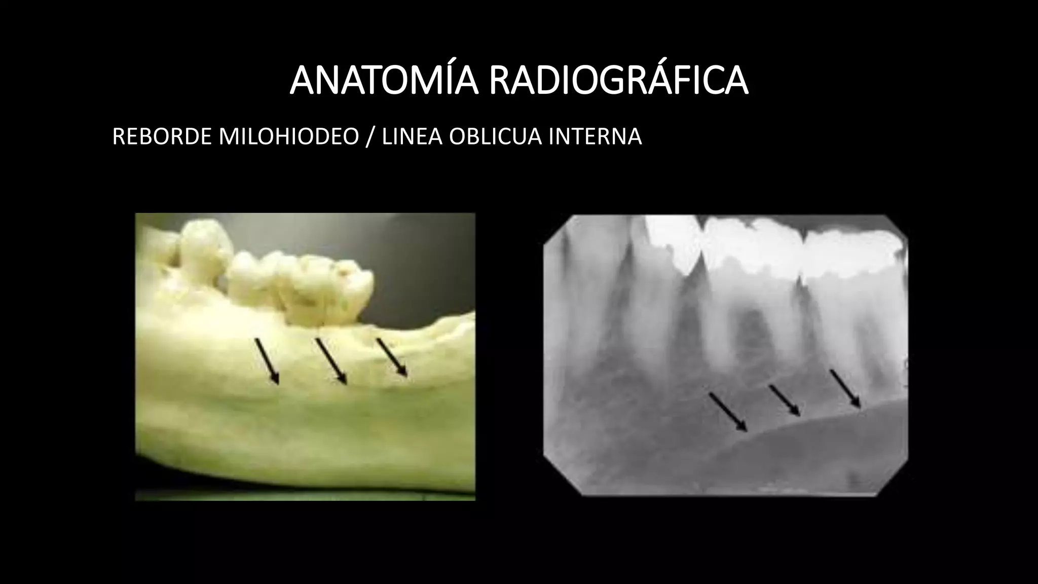 ANATOMÍA RADIOGRAFICA MAXILAR INFERIOR | PPT