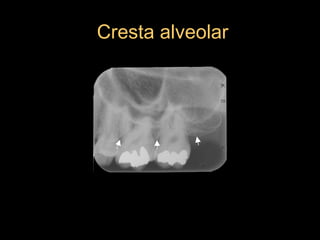 Anatomía radiográfica intraoral | PPT